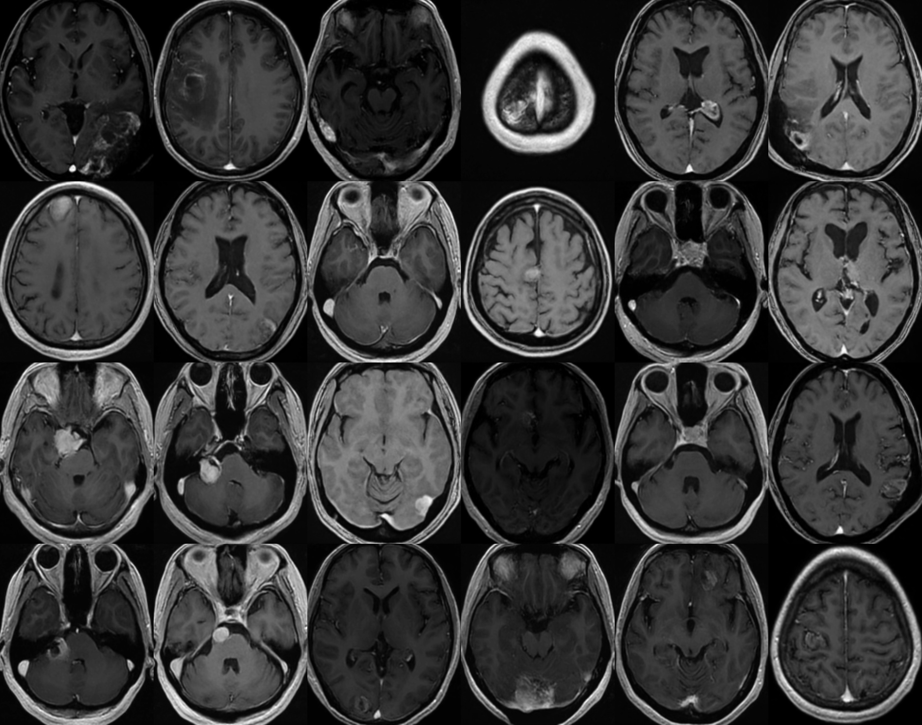 Intracranial Tumor Segmentation Icts Challenge 2022 